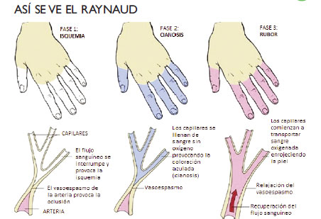 Raynaud, la enfermedad del frío y los dedos azules que afecta más a las ...